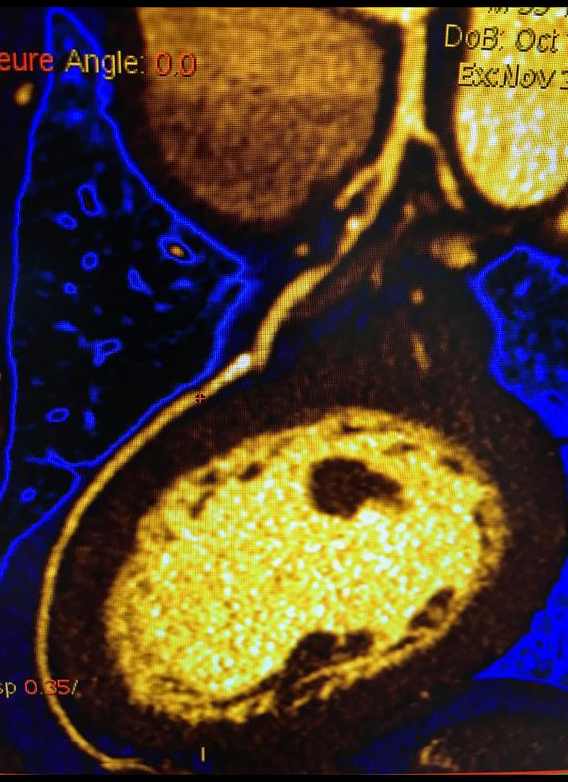 Scanner coronaire (ou coroscanner) - Centre Cœur et Santé